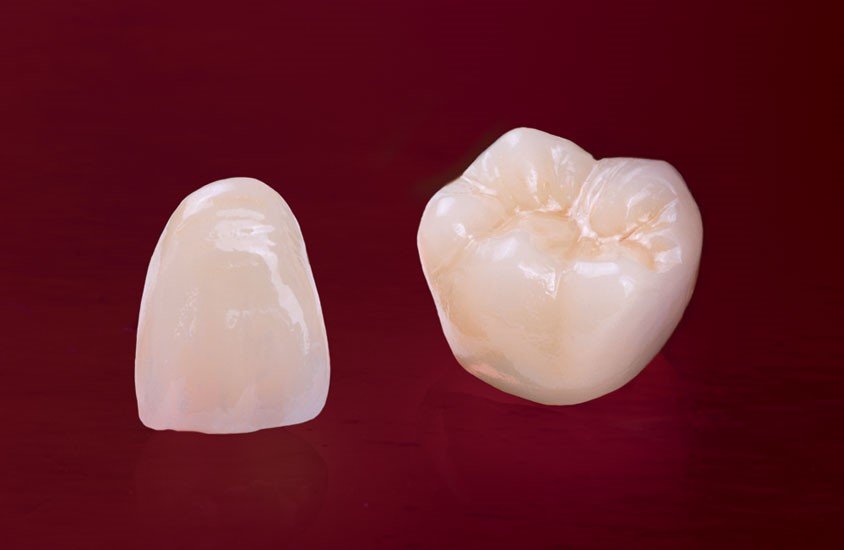 Dental Crowns Mission - Dental Restorations TX
